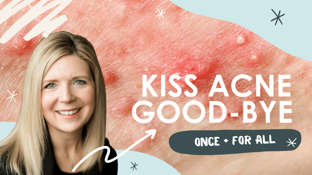 Kiss Your Acne Good-Bye Once + For All - Estetica Spa