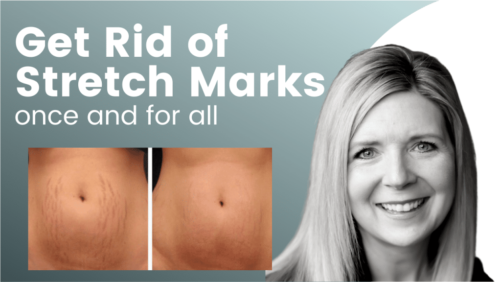 Kiss your Stretch Marks Goodbye! - Estetica Spa